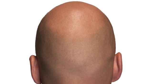 Baldness – a blessing or a curse? – A Geordie In Girona